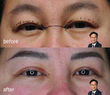 Cosmetic Upper Eyelid Surgery (Blepharoplasty) - Cosmetic ...