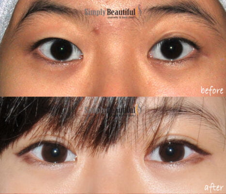 Asian Eyelid Surgery Cosmetic Blepharoplasty Sydney Dr Peter Kim