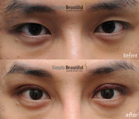 Asian Eyelid Surgery Cosmetic Blepharoplasty Sydney Dr Peter Kim