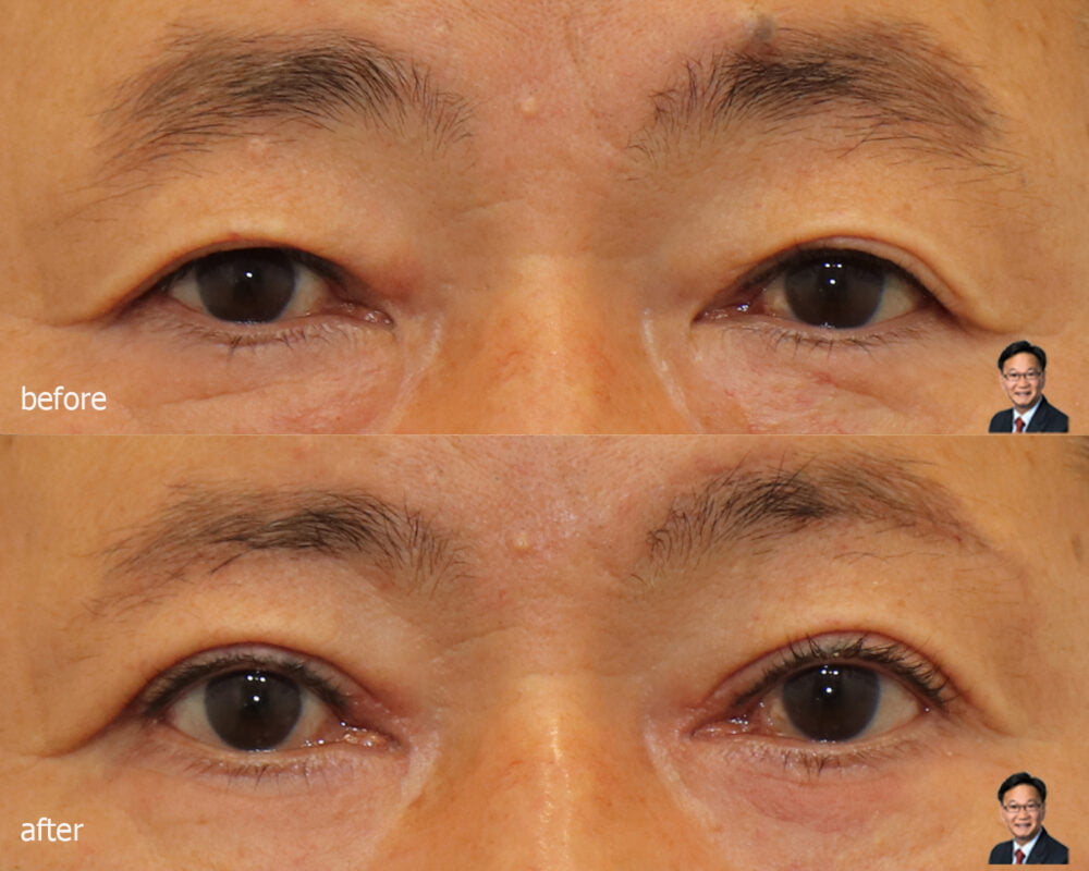 Asian Eyelid Surgery - Cosmetic Blepharoplasty Sydney - Dr Peter Kim
