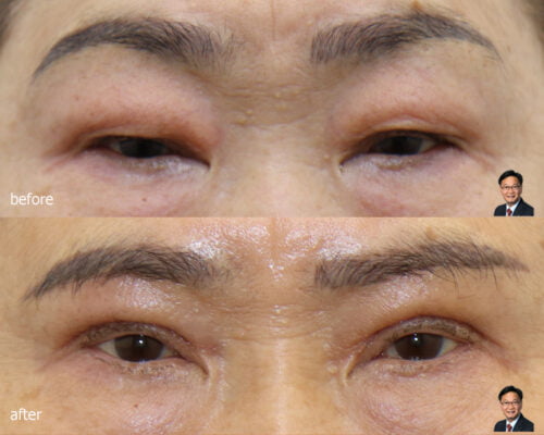Asian Eyelid Surgery - Cosmetic Blepharoplasty Sydney - Dr Peter Kim