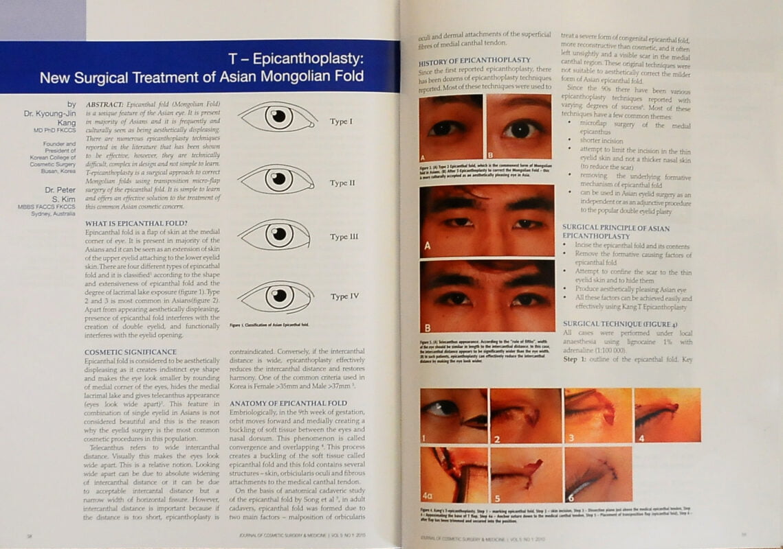 Double Eyelid Surgery - Cosmetic Blepharoplasty Sydney - Dr Peter Kim