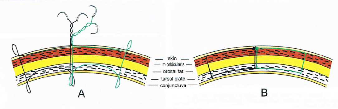 Double Eyelid Threads - Creating Double Eyelids Without Surgery ...